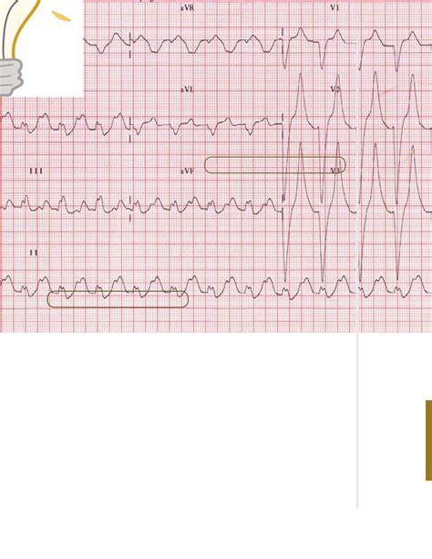 Hyperkalemia And Hypokalemia Notes Diagrams And Download Pdf Osmosis
