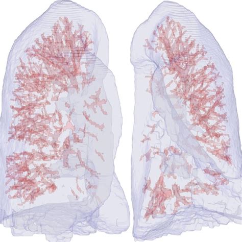 A 69 Year Old Woman Was Diagnosed With Ipf With A Probable Uip Pattern Download Scientific