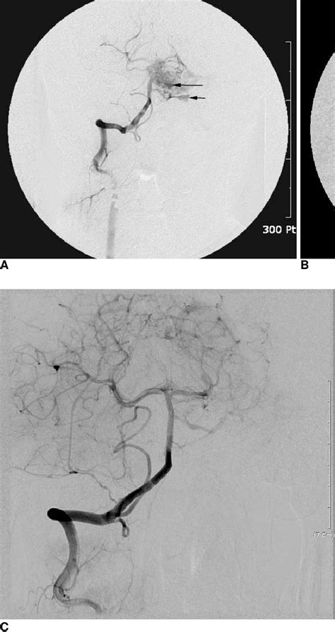 Case A Anteroposterior View Of Right Vertebral Artery Angiogram