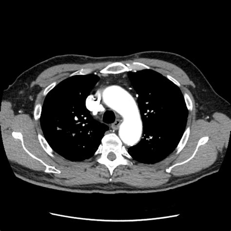 Radiopaedia Case Hemangioblastoma Spinal Cord Id 61112 Study 68989