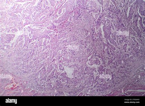 Photomicrograph Of Mucinous Carcinoma In The Stomach Displaying