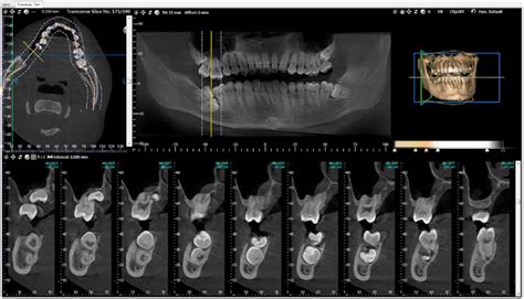 Pre Treatment Cbct Images Tooth 47 48 Were Horizontal Impacted And