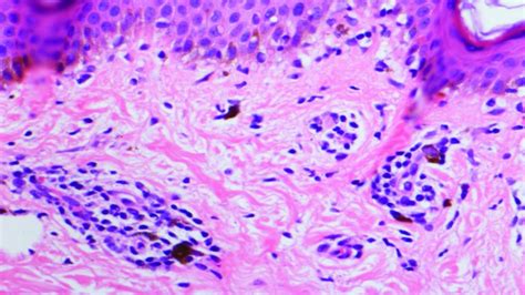 A Case Of Lichen Planus Pigmentosus With Facial Dyspigmentation