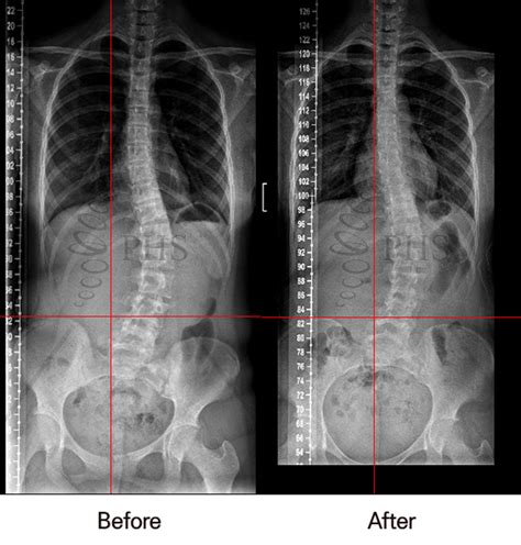 척추측만증 18세 요추 6도개선 전후영상 Phs