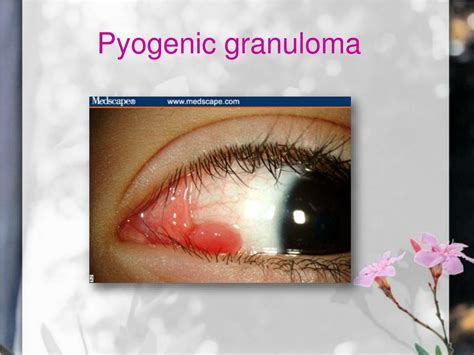 Ppt Complications Following Strabismus Surgery Powerpoint