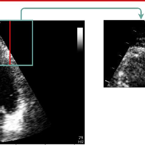 Temporal Sliding Window Depicting The Process Of Extracting 2
