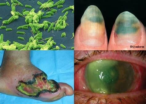 Pseudomonas Bacteria