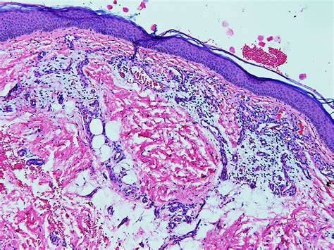Histopathology Of Vascular Malformations Dermatologic Clinics