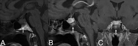 Diffuse Basisphenoid Enhancement Possible Differentiating Feature For Granulomatous