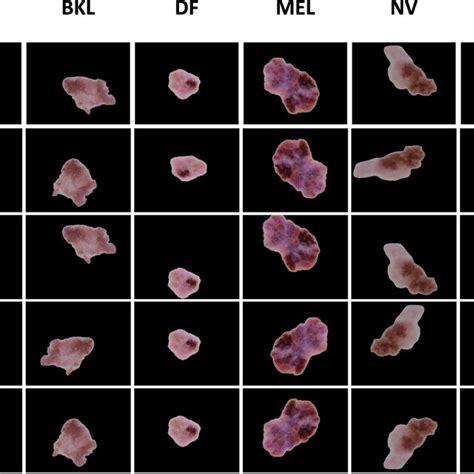 Illustration Of The Lesion Shaped Expansion Algorithm Download