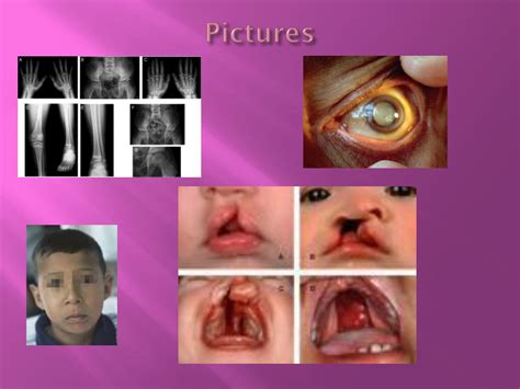 Ppt Sticklers Syndrome Powerpoint Presentation Free Download Id 2031799