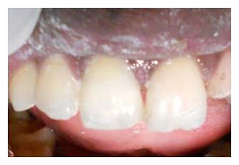 A Preoperative View B Fractured Segment C Postobturation 11