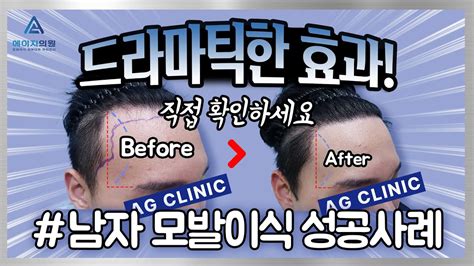 2남성 모발이식 1년 후기영상🙎‍♂️ 결과로 말씀드리겠습니다 부산 에이지의원 Youtube