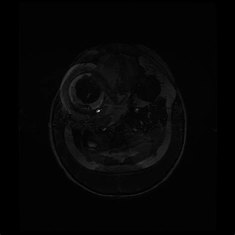 Cochlear Incomplete Partition With Lateral Semicircular Canal Dysplasia