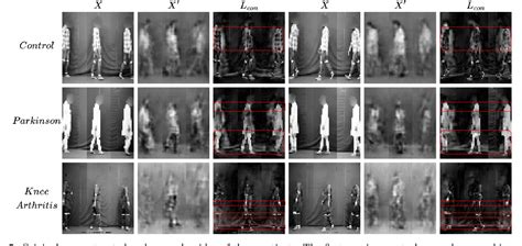Figure 5 From Parkinson Gait Modelling From An Anomaly Deep