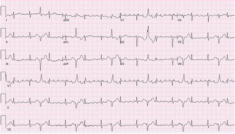 Twelve Lead Ecg Of Atrial Flutter With Varying Conduction Download Scientific Diagram
