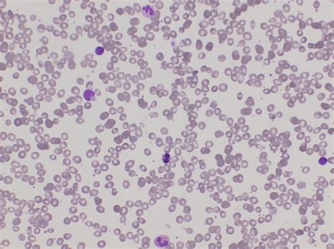 Bone Marrow Biopsy From Our Patient Showing Erythroid Hypercellularity Download Scientific