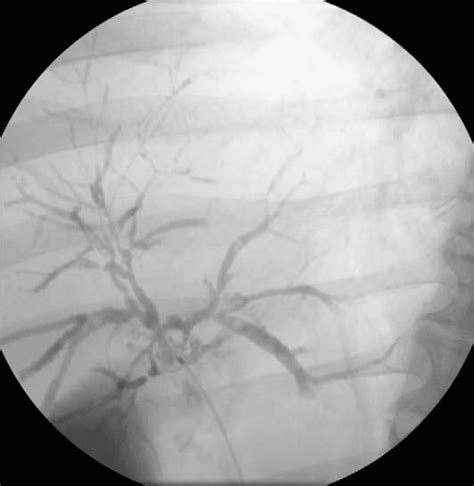 Figure 1 From Sclerosing Cholangitis Primary Intrahepatic And