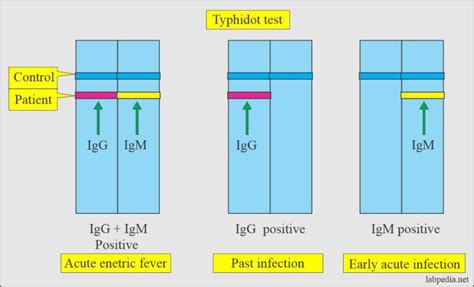 Typhoid Fever Enteric Fever Salmonella Typhi