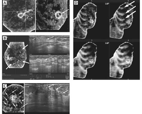Normal Breast Anatomy On Abus A The Normal Nipple Areolar Complex