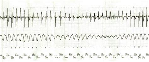 Portion Of The Electrogram From Interrogation Of The Patients Icd On Download Scientific