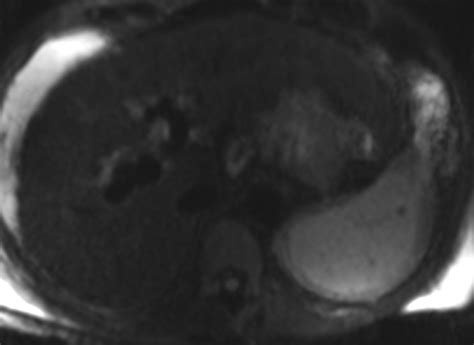 Iron Absorption Liver Cirrhosis At Rose Briggs Blog