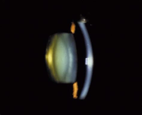 Cataract Clinical Types Ento Key