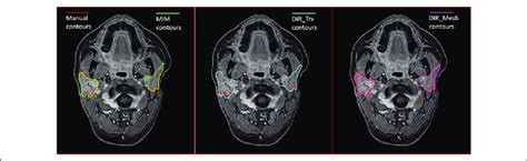 Examples Of Contour Propagation Using Mim Left Dir Trx Center And Download Scientific