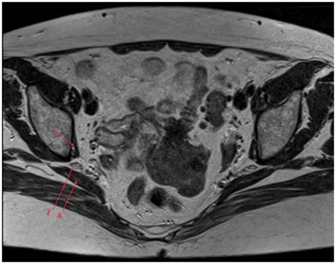 Sciatic Foramen Mri
