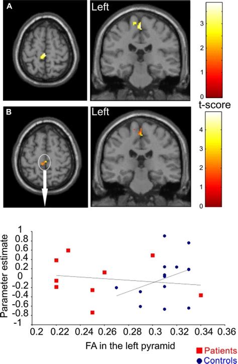 A Statistical Parametric Maps Thresholded At P Download Scientific