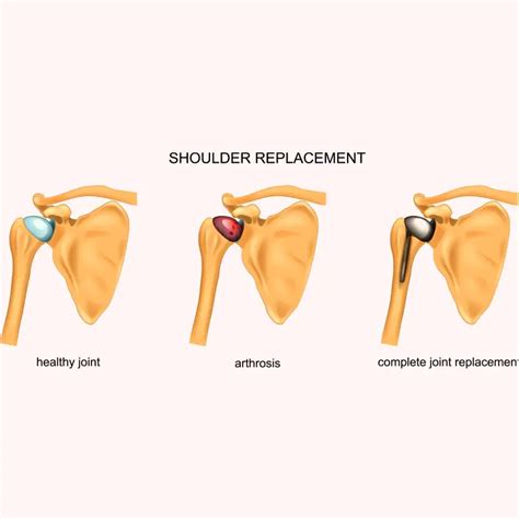Shoulder Arthroplasty Types Conditions Treated And Innovations