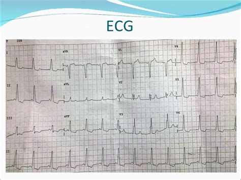 ECG WPW Syndrome