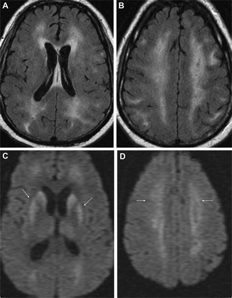 Toxic And Drug Related White Matter Diseases Of The Brain And Spine