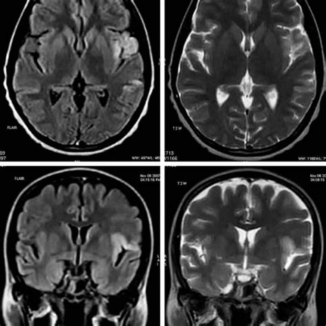 Serial Sections Showing Ill Defined Hyperdensity And Faint Enhancement Download Scientific