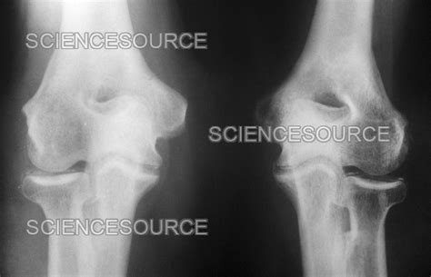 Chondrocalcinosis X Ray Stock Image Science Source Images