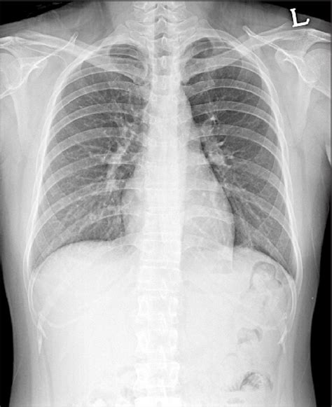 Initial Posteroanterior Chest Radiograph Shows No Specific Abnormality