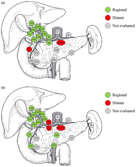 Benefit Of Lymph Node Dissection For Perihilar And Distal