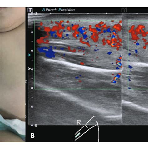 A Red Discoloration And Swelling Of The Right Forearm Up To The Download Scientific Diagram