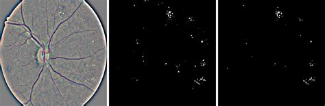 Github Sourjya261 Idrid Ex Segmentation Semantic Segmentation Of