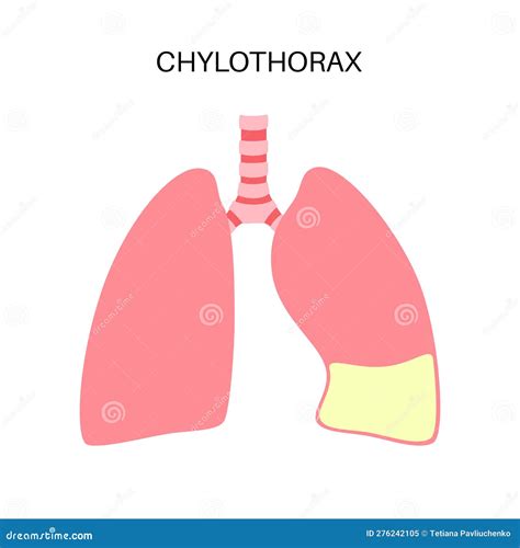 Chylothorax Lung Diseases Healthcare Medical Infographic Banner