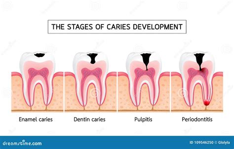 Dental Caries Process At Buddy Byram Blog