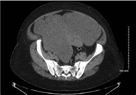 Pre Operative Ct Scan Download Scientific Diagram