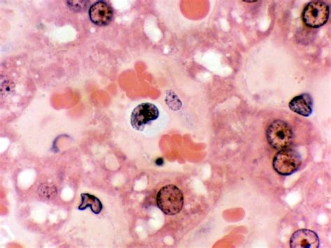 Proč Jsou Monocyty Zvýšené