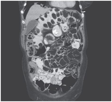Intestinal Lipomatosis MEDizzy