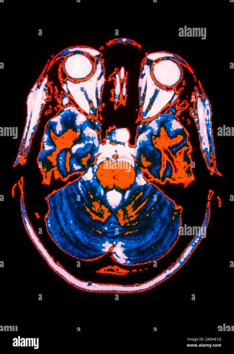 Stroke Coloured Computed Tomography Ct Scan Of A Brain Affected By A Cerebrovascular Accident