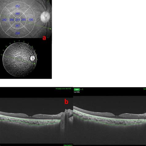 Measurement Of Choroidal Thickness Using The Built In Software In Download Scientific Diagram