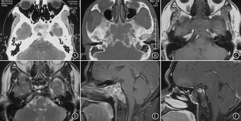 Osteosarcoma Of The Skull Base An Analysis Of 19 Cases And Literature