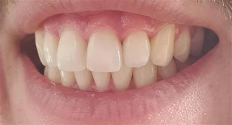 Braces Came Off Scrolller