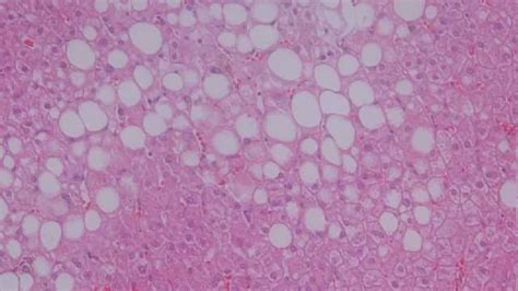 Fatty Liver Histology