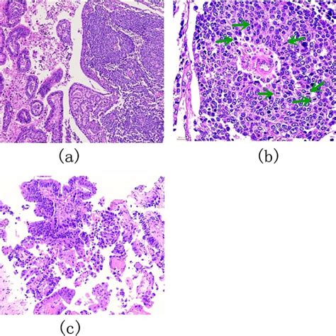 Case 2 Gross Pathological Findings Of The Resected Gallbladder And